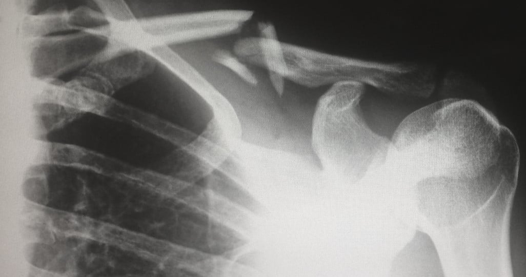 What Is Tort Law with Examples