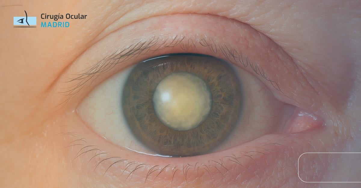 Visión borrosa: causas, tratamiento y cuándo acudir al médico