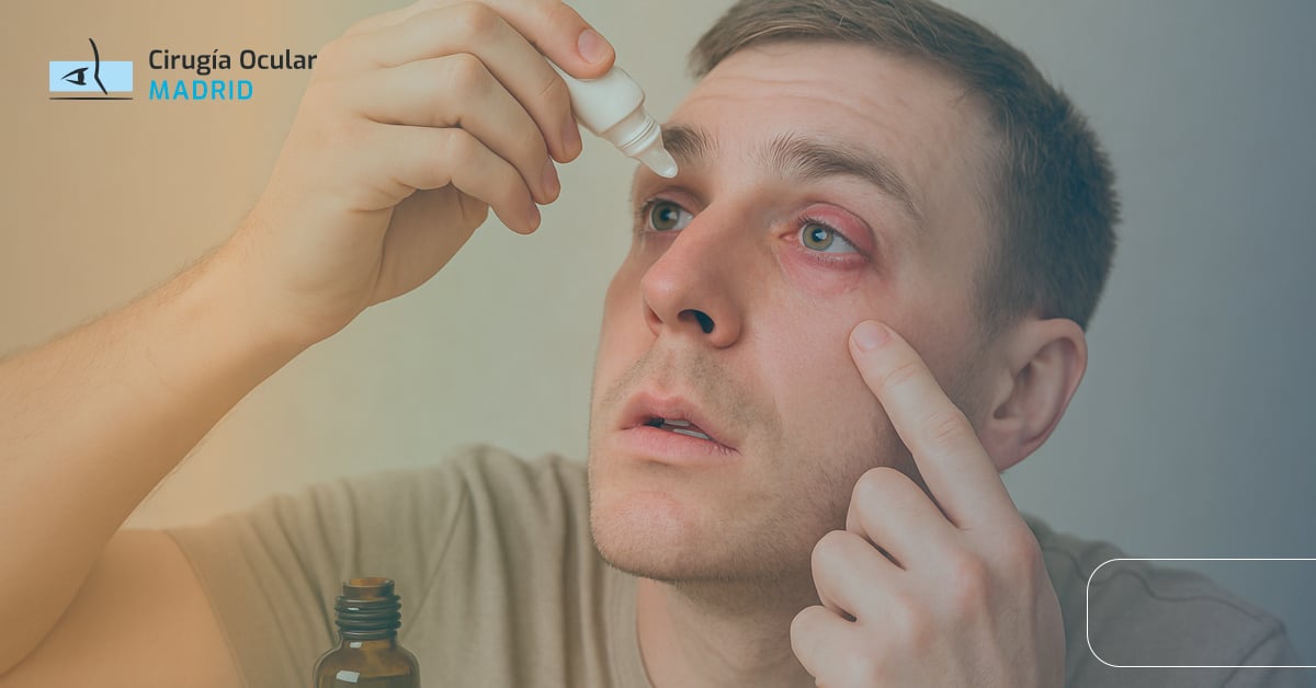 Conjuntivitis vírica: tratamiento y prevención