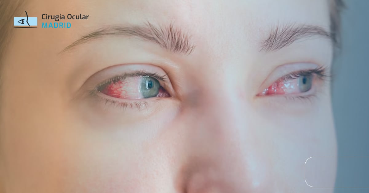 Manchas rojas en los ojos: causas, síntomas, tratamiento y prevención