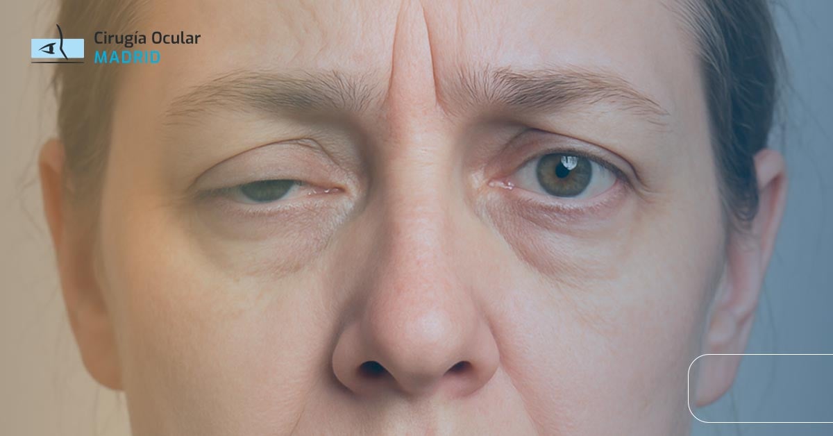 Miastenia Ocular: Síntomas, Causas y Tratamiento Completo