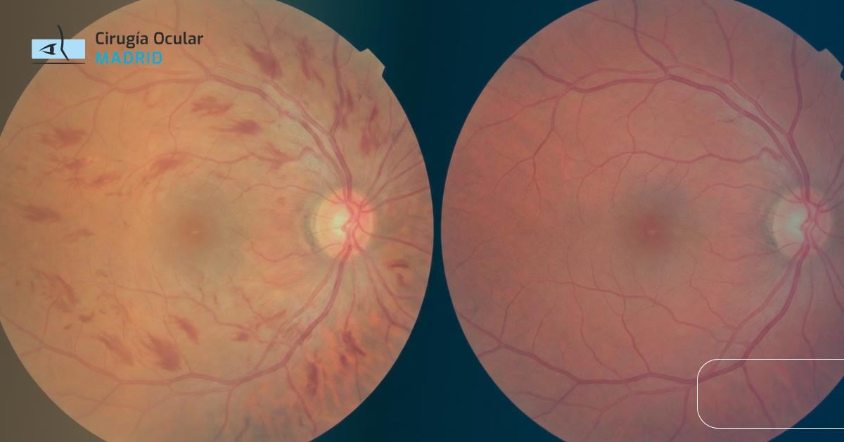 Cuerpo Ciliar: Anatomía, Funciones y Patologías