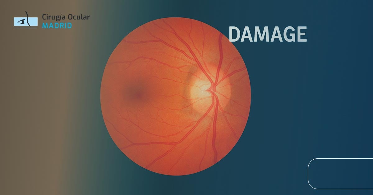 Nervio Óptico Dañado: Síntomas, Causas y Tratamiento