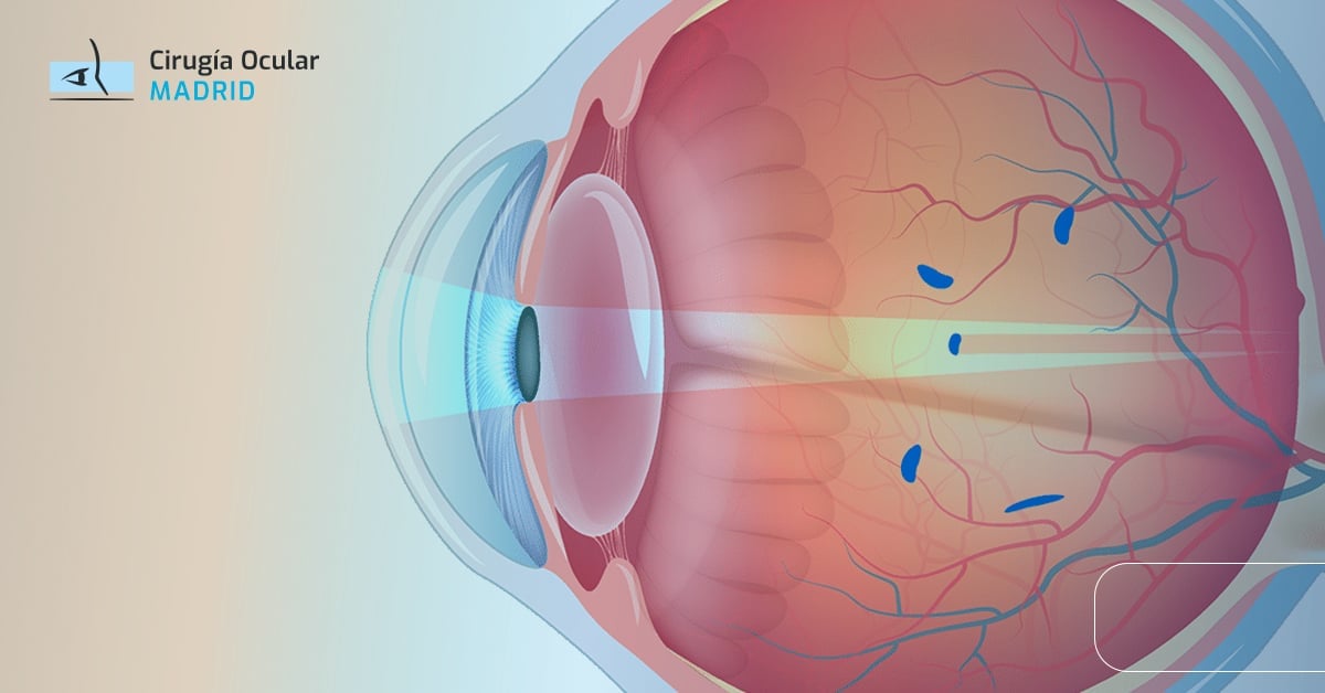 Miodesopsias. ¿Qué es? Síntomas, causas y tratamiento