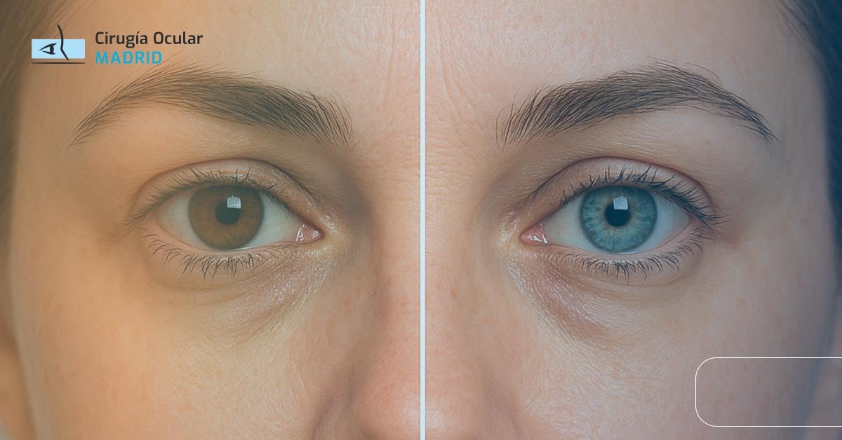 Párpados Hinchados: Causas, Síntomas y Tratamientos