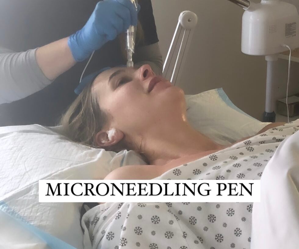 Microneedling: My Before And After Results - Gurl Gone Green