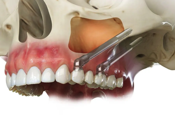 Zygomatic Implants for Severe Bone Loss | HCT Dental Clinic