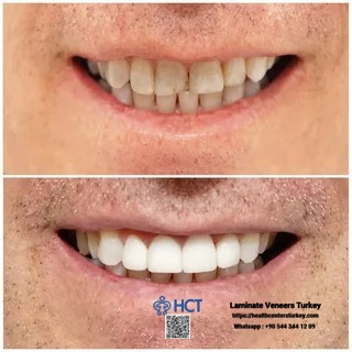 Dental Holiday in Turkey | All-inclusive Packages in Antalya