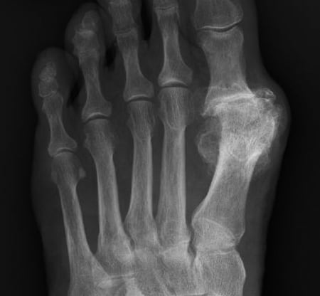 Hallux rigidus - Shark Screw®