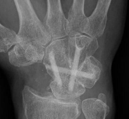 Slac Wrist - Shark Screw®