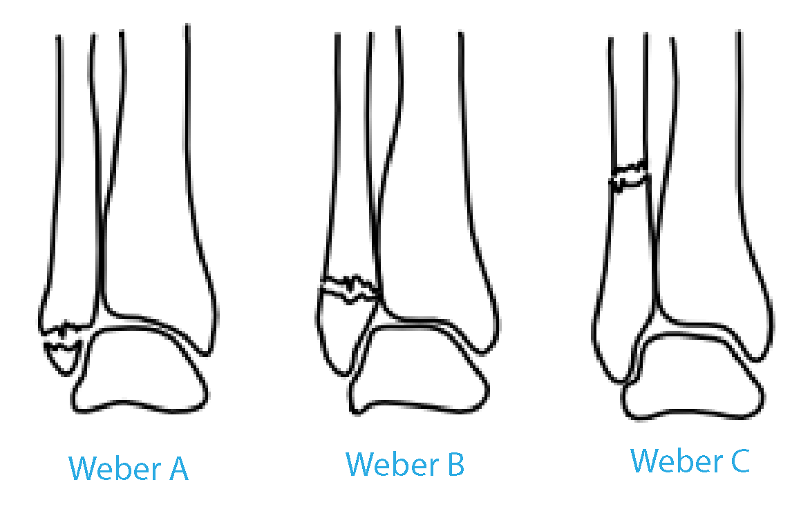 Sprunggelenksfraktur: Natürliche Heilung, Behandlung & Methoden